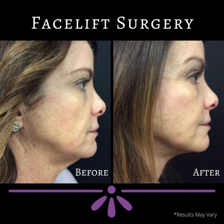 4 Tips on How to Care for Skin After Facial Surgery and Fillers | Dr ...